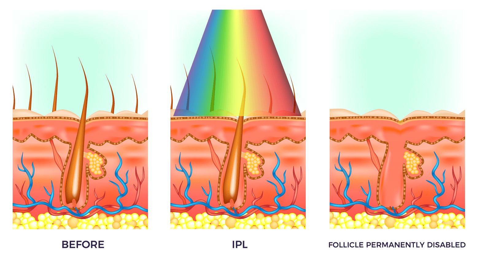 Permanent Hair Removal Singapore - IPL | Expressions